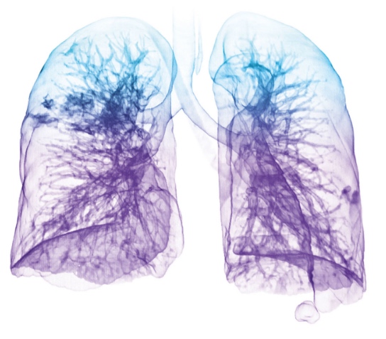 Diagnostic And Therapeutic Pulmonary Device Company Pulmonx Raises $65 ...
