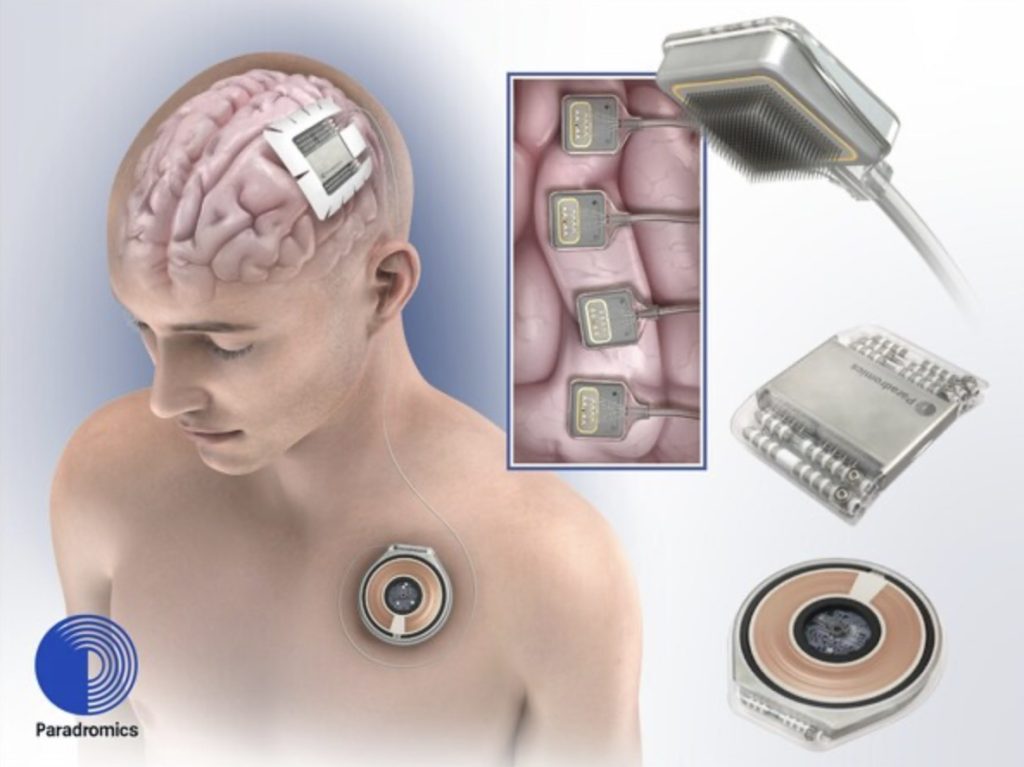 Paradromics: Brain-Computer Interface Company Secures $33 Million In ...